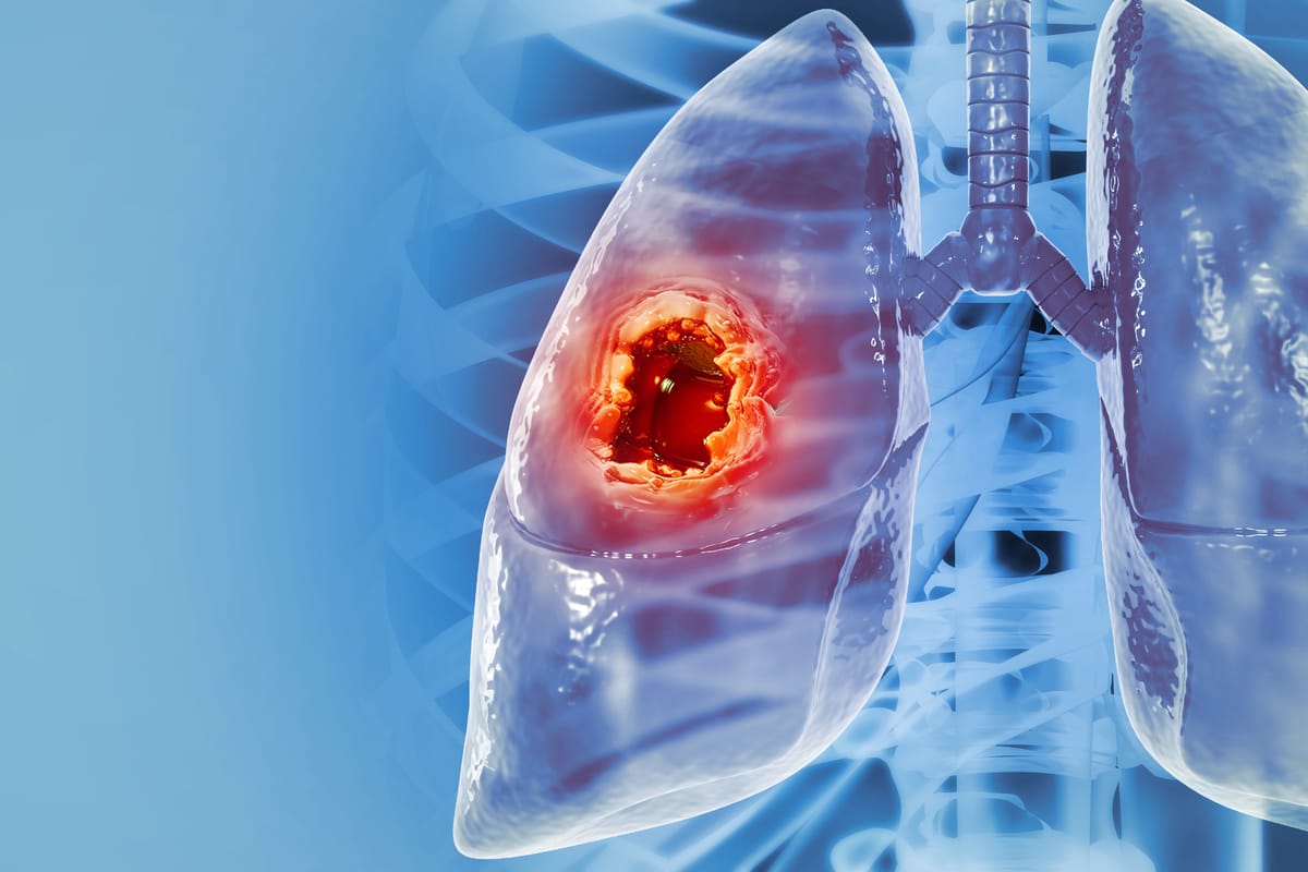 Israeli lung cancer rates declining, smokers overwhelmingly at risk